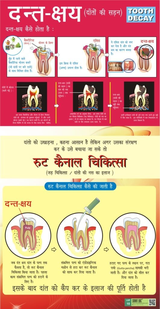 LDP-10 ( H) Root canal treatment + occurence & Progression of Dental ...